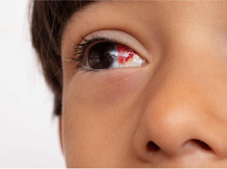 Blood Clot In The Eye - Clarity Eye Center