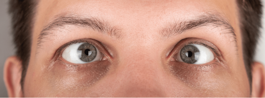 Strabismus "Cross Eye" - Clarity Eye Center